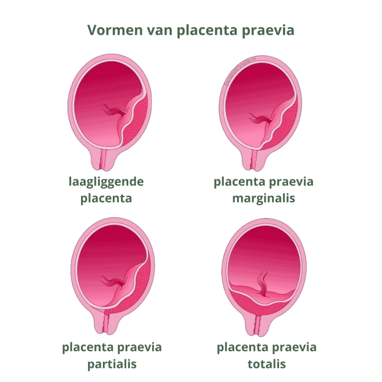 Placenta praevia - Eenkeizersnede.nl